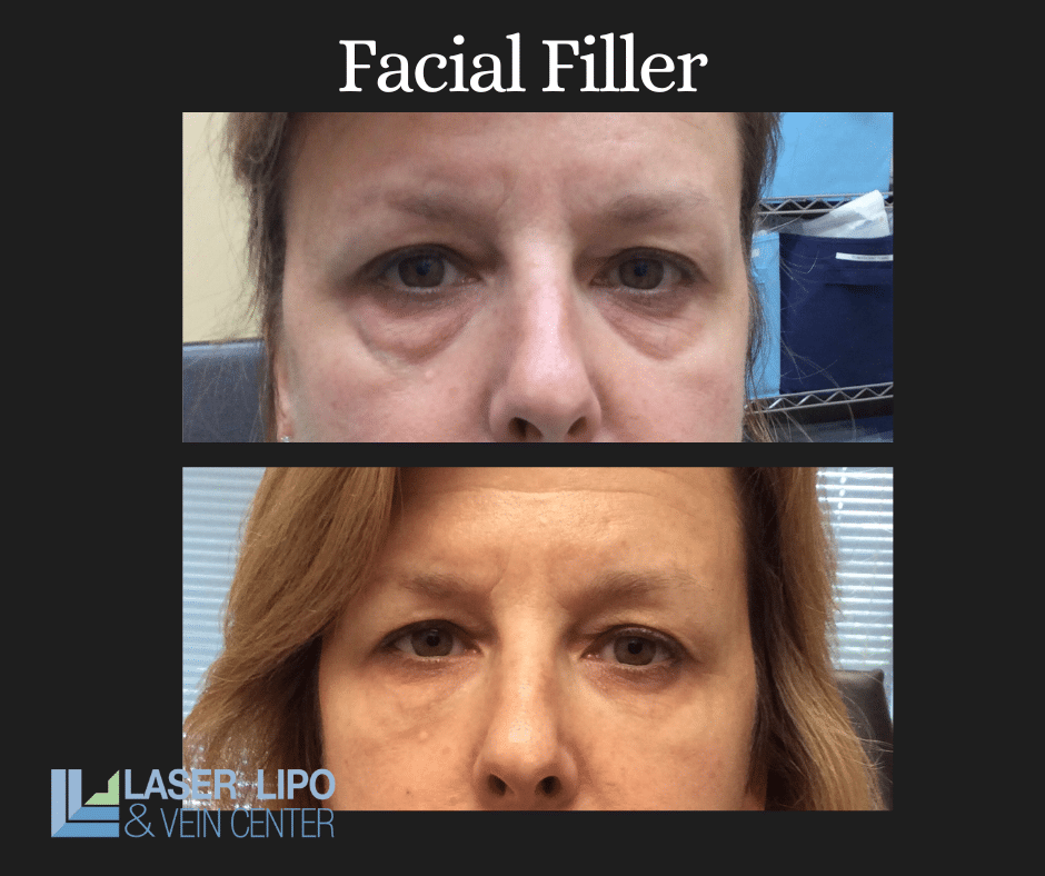 Fillers Before & After (1) - St Louis Lipo