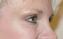 Learn How ot Pick A Dermatologist for Botox Procedures | St Louis Lipo