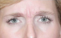 Cosmetic Botox in St Louis | St. Louis Liposuction Center