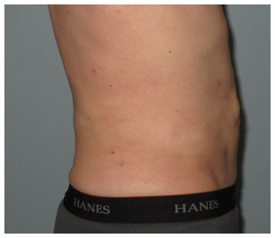 How Long to Recover From Liposuction? | St. Louis Lipo Recovery