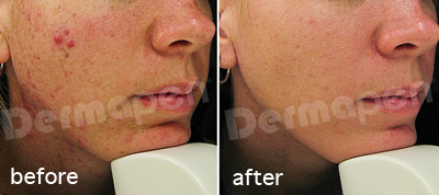 Dermapen Treatments in St. Louis | St. Louis Laser Liposuction Center
