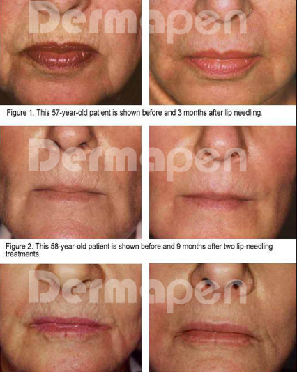 Get Rid of Scars, Lines, and Acne with St. Louis Skin Resurfacing | St ...