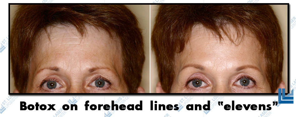 Cosmetic Botox in St Louis | St. Louis Liposuction Center