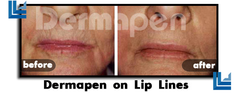 Dermapen Treatments in St. Louis | St. Louis Laser Liposuction Center