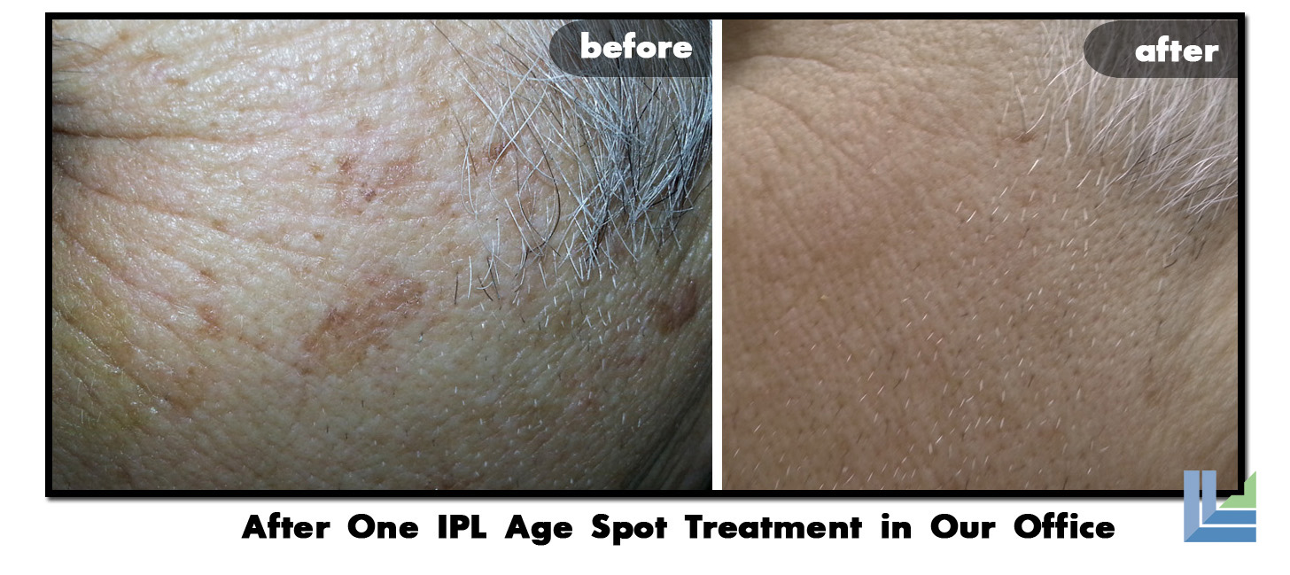 Best Laser Skin Rejuvenation and Treatments | St Louis Laser ...