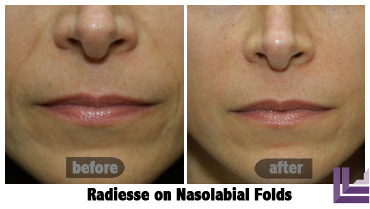 Radiesse Dermal Fillers and Injections in St. Louis | St. Louis Laser ...