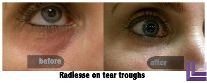 Radiesse Dermal Fillers and Injections in St. Louis | St. Louis Laser ...