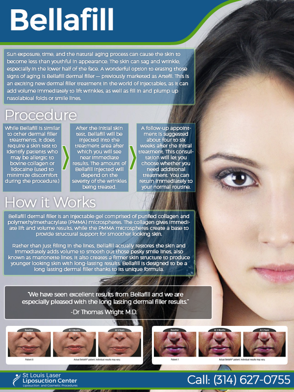 Bellafill Long Lasting Dermal Filler | Dermal Filler Treatment | SLL