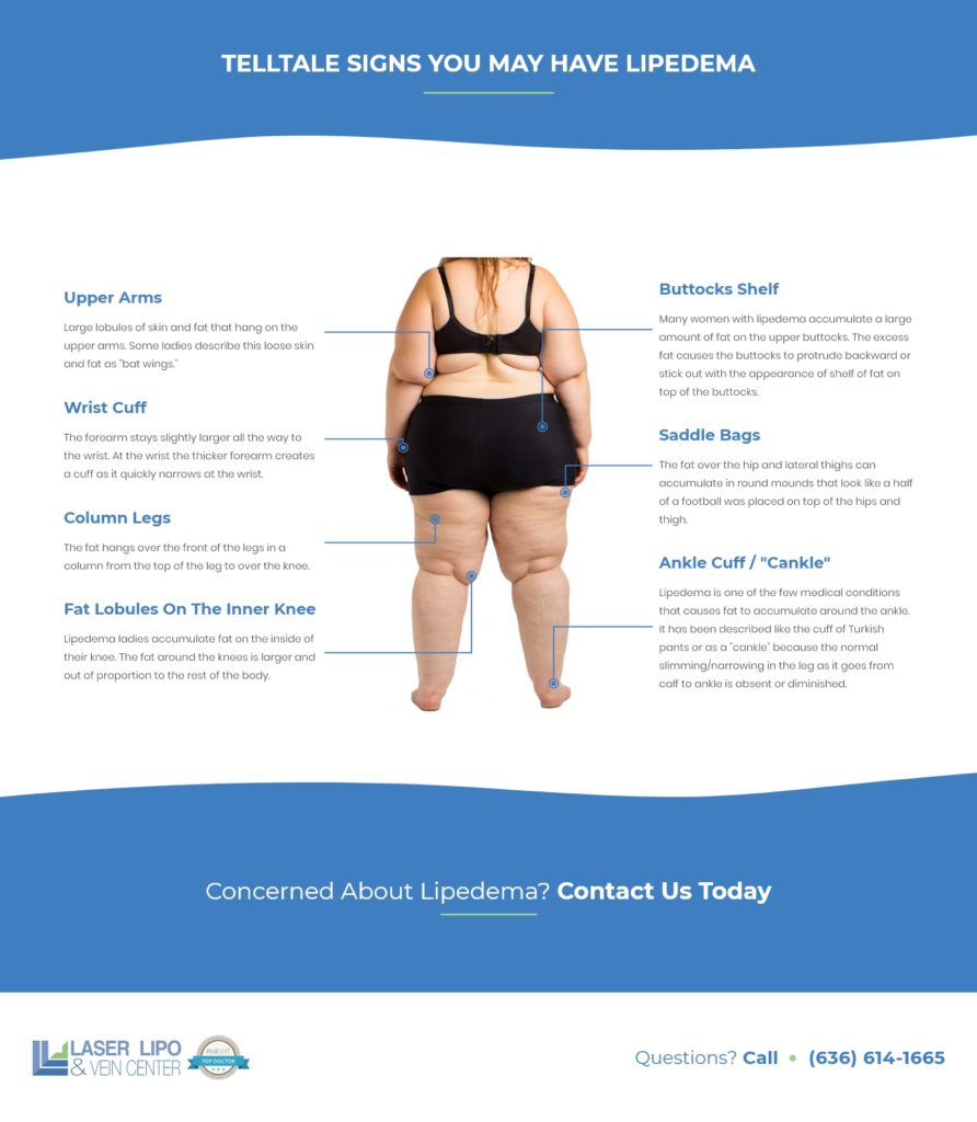 Signs of Lipedema | Lipedema St Louis | St Louis Liposuction Center