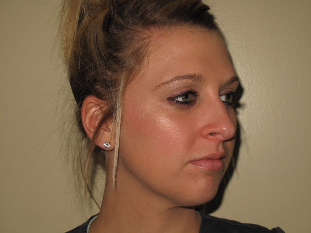 Bellafill Long Lasting Dermal Filler | Dermal Filler Treatment | SLL