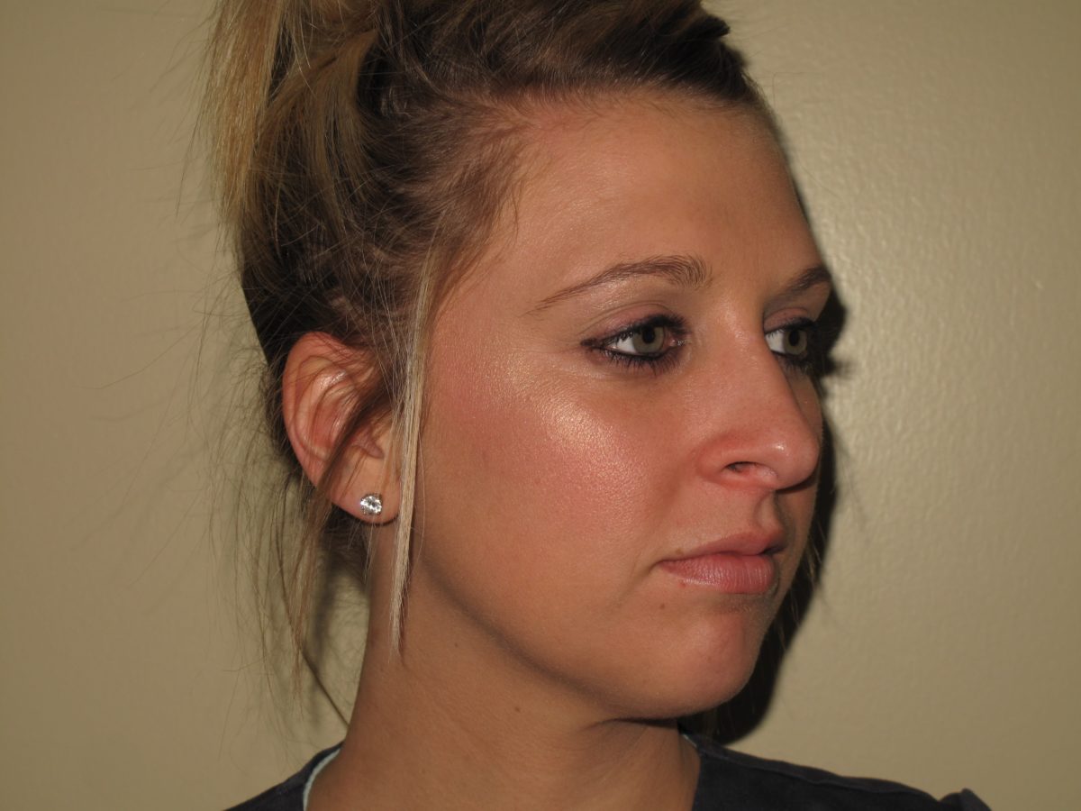 Bellafill Long Lasting Dermal Filler | Dermal Filler Treatment | SLL