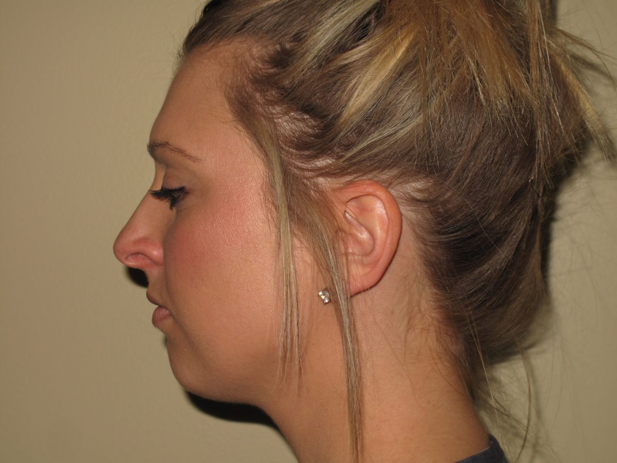 Bellafill Long Lasting Dermal Filler | Dermal Filler Treatment | SLL