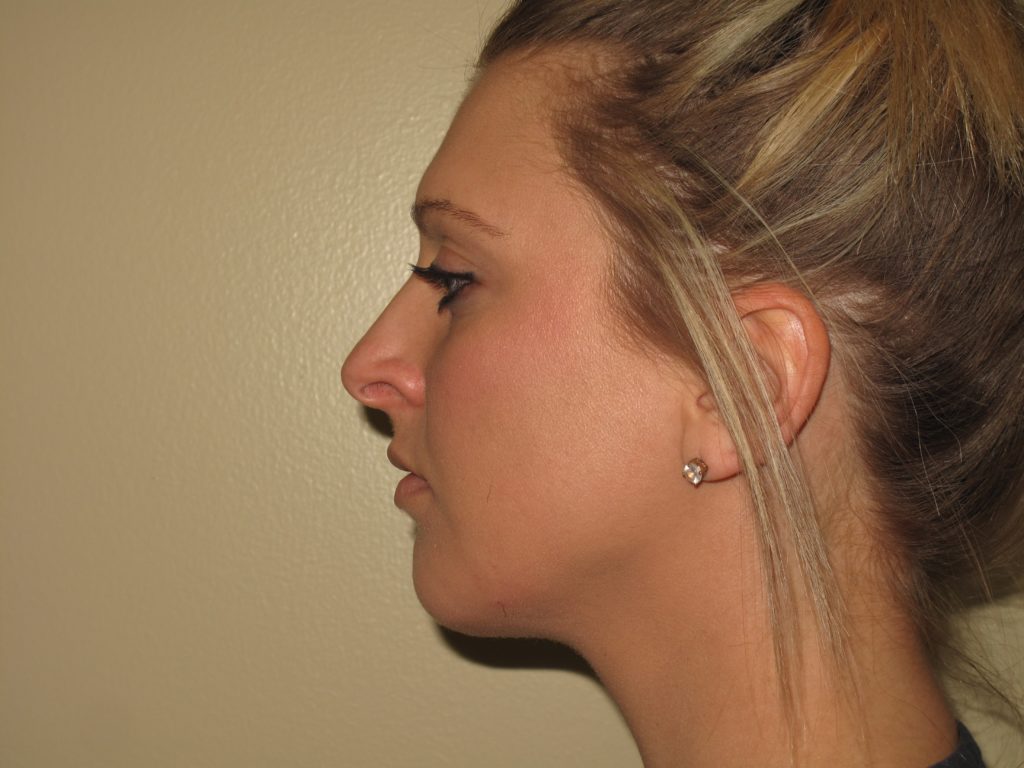 Bellafill Long Lasting Dermal Filler | Dermal Filler Treatment | SLL