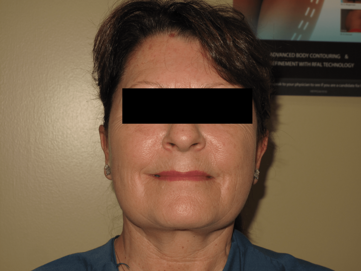 Fat Grafting and Transfer Liposuction | St Louis Lipo Center