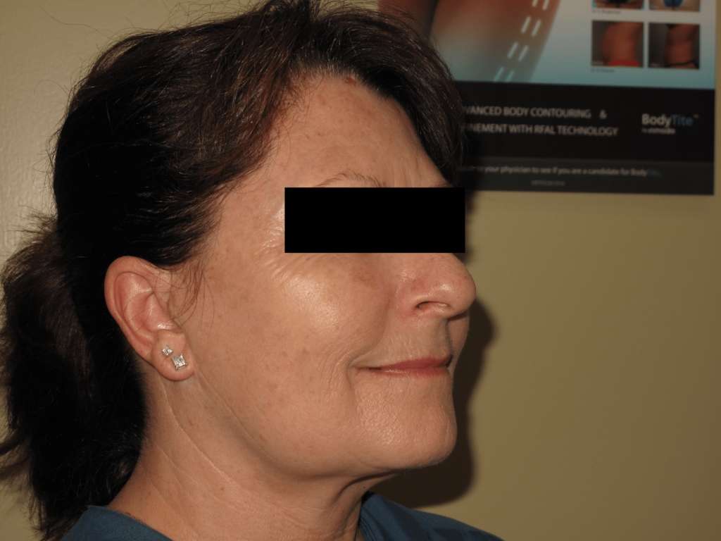 Fat Grafting and Transfer Liposuction | St Louis Lipo Center