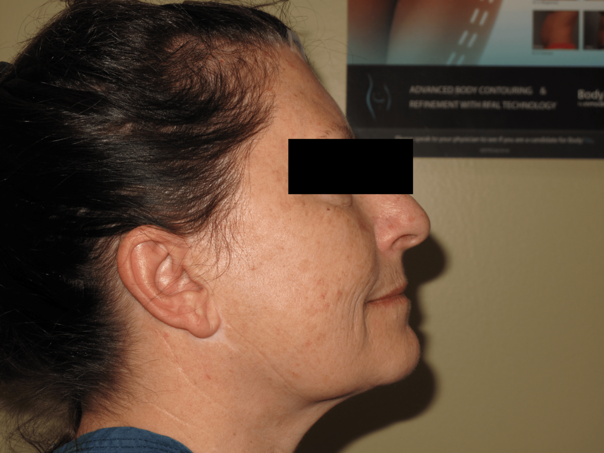 Fat Grafting and Transfer Liposuction | St Louis Lipo Center