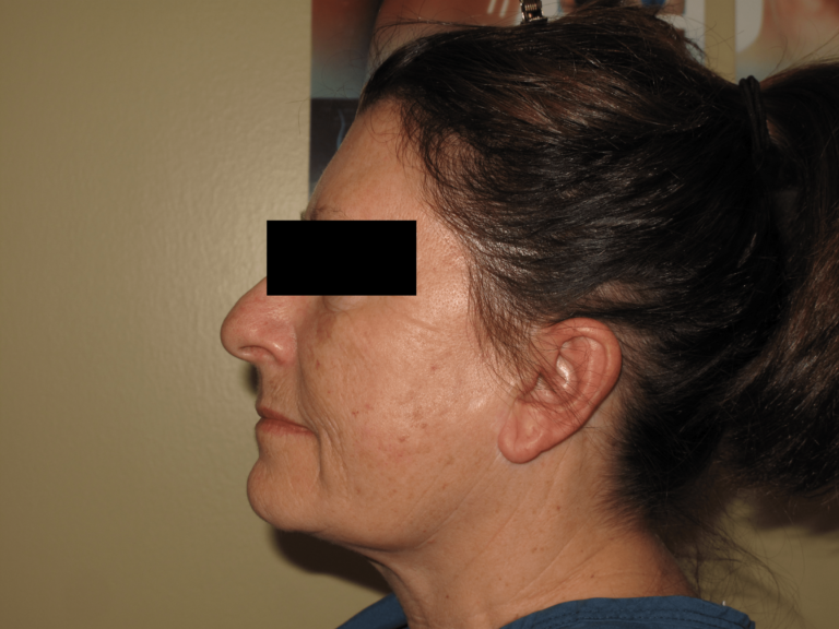 Fat Grafting and Transfer Liposuction | St Louis Lipo Center