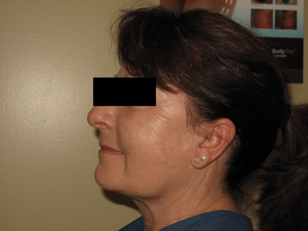 Fat Grafting and Transfer Liposuction | St Louis Lipo Center