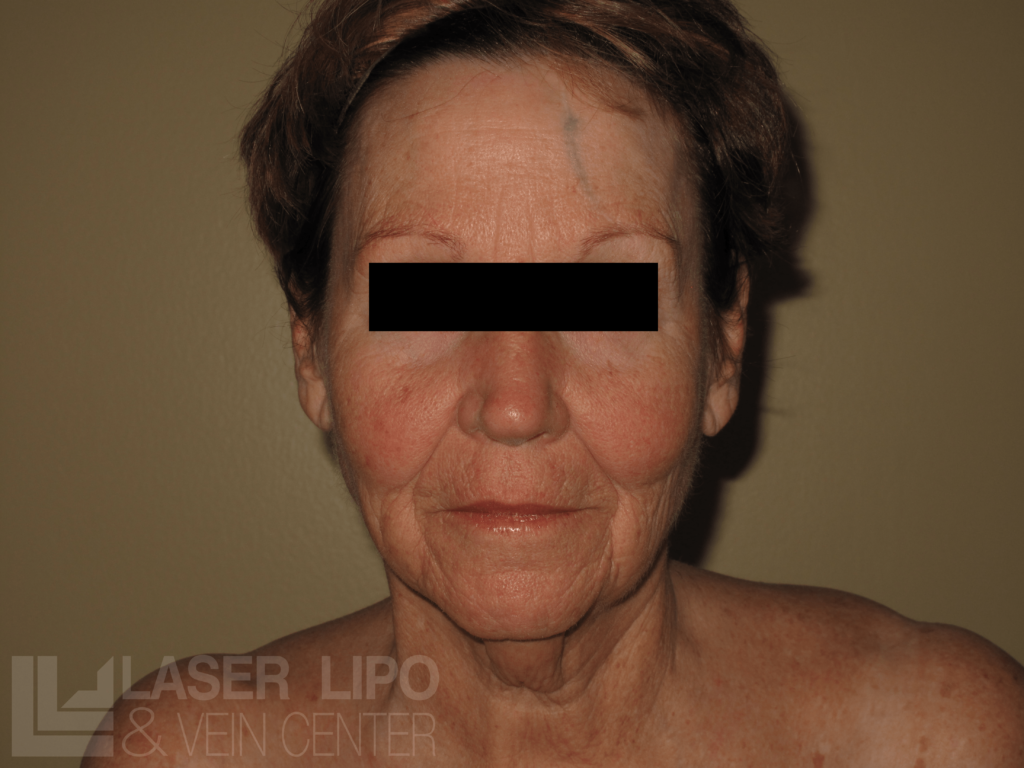 Fat Grafting and Transfer Liposuction | St Louis Lipo Center