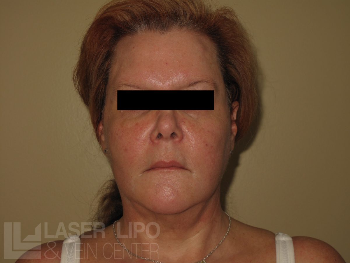 Fat Grafting and Transfer Liposuction | St Louis Lipo Center