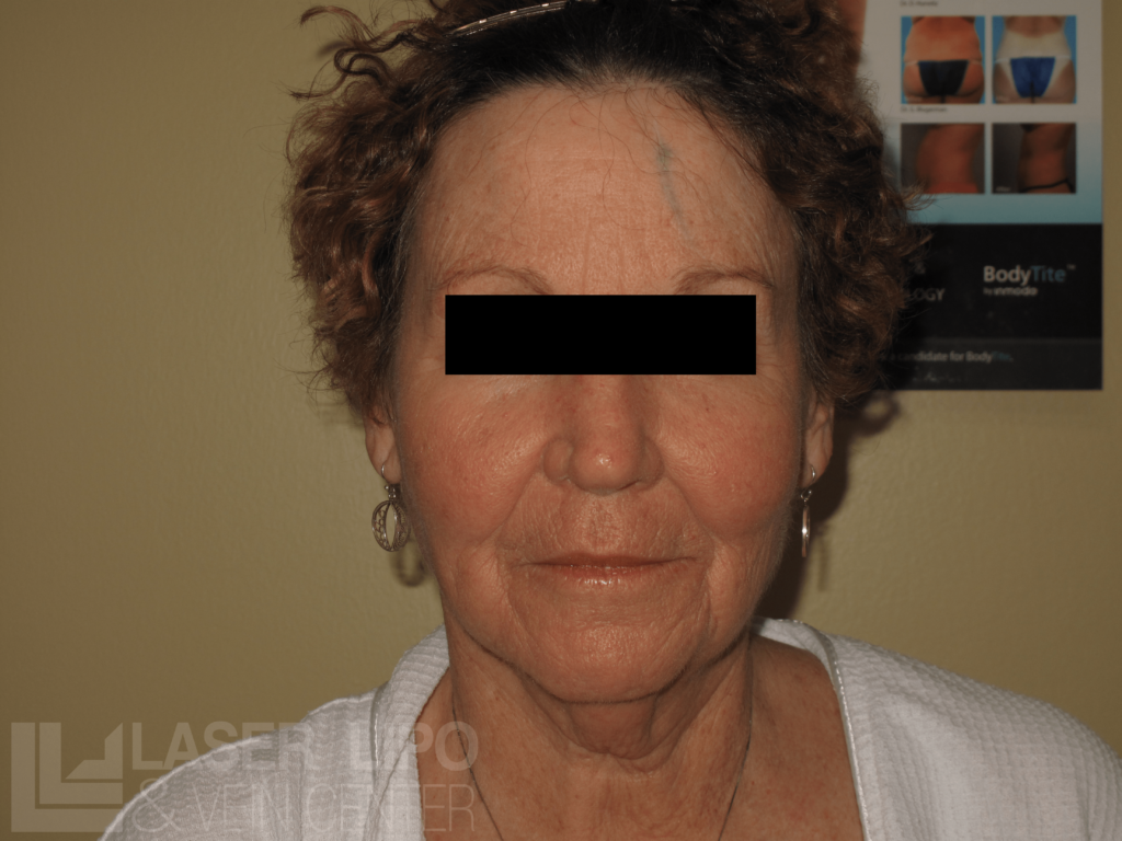 Fat Grafting and Transfer Liposuction | St Louis Lipo Center