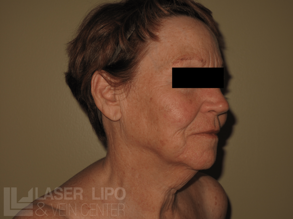 Fat Grafting and Transfer Liposuction | St Louis Lipo Center