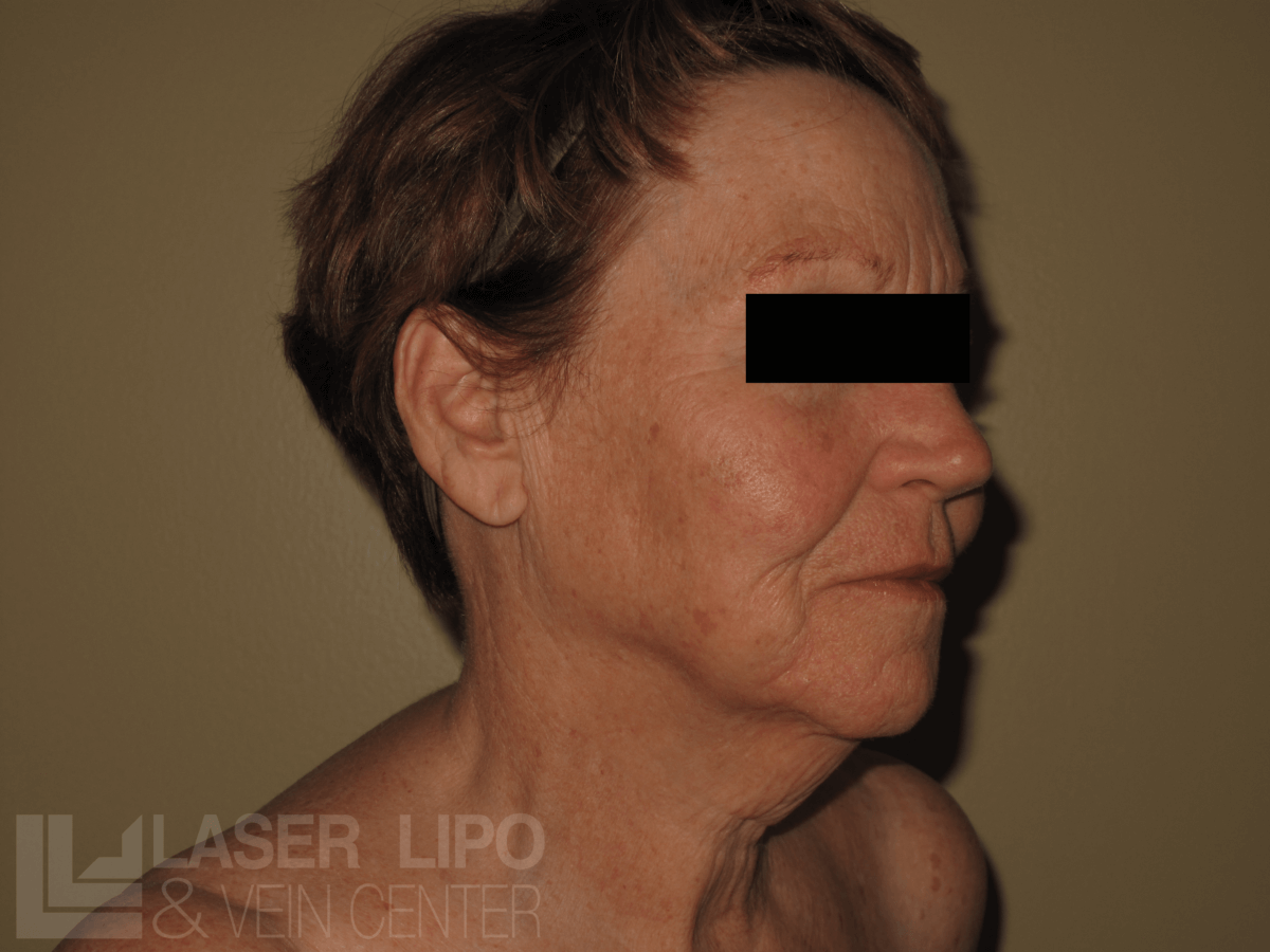 Fat Grafting and Transfer Liposuction | St Louis Lipo Center