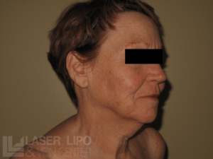 Fat Grafting and Transfer Liposuction | St Louis Lipo Center