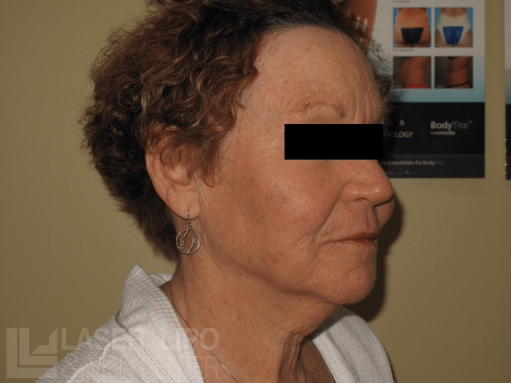 Fat Grafting and Transfer Liposuction | St Louis Lipo Center