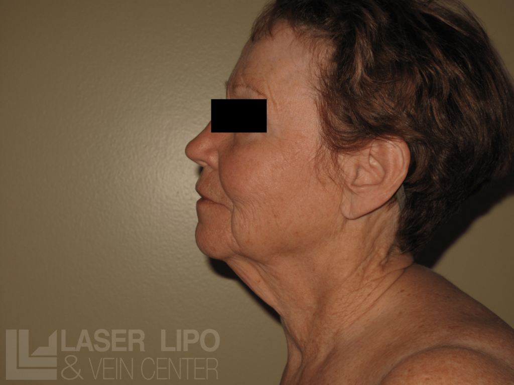 Fat Grafting and Transfer Liposuction | St Louis Lipo Center