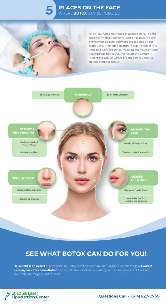 5 Places On The Face Where Botox Can Be Injected Slllc St Louis Lipo