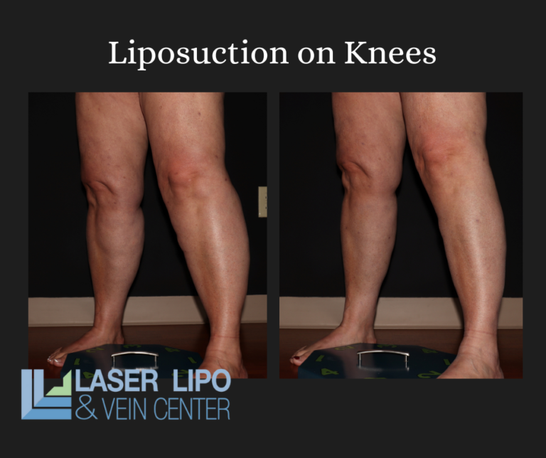 Knee Liposuction | Cost of Lipo on Knees | St. Louis Liposuction
