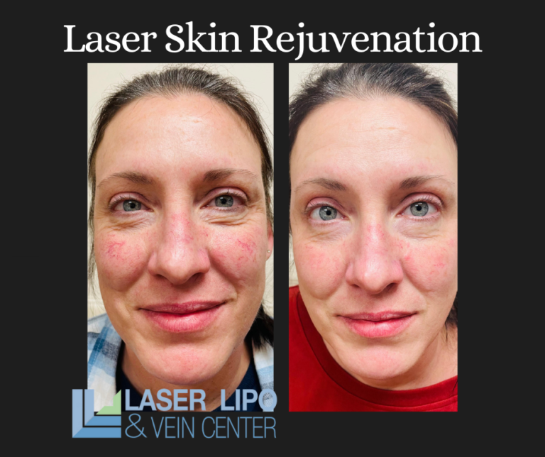 Lumecca Light Therapy Skin Resurfacing Treatments | St. Louis Liposuction