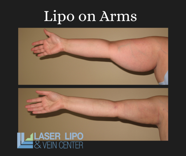 Arm and Underarm Liposuction | St Louis Lipo