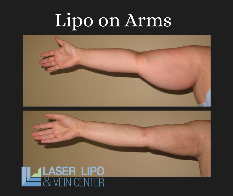 Arm and Underarm Liposuction | St Louis Lipo