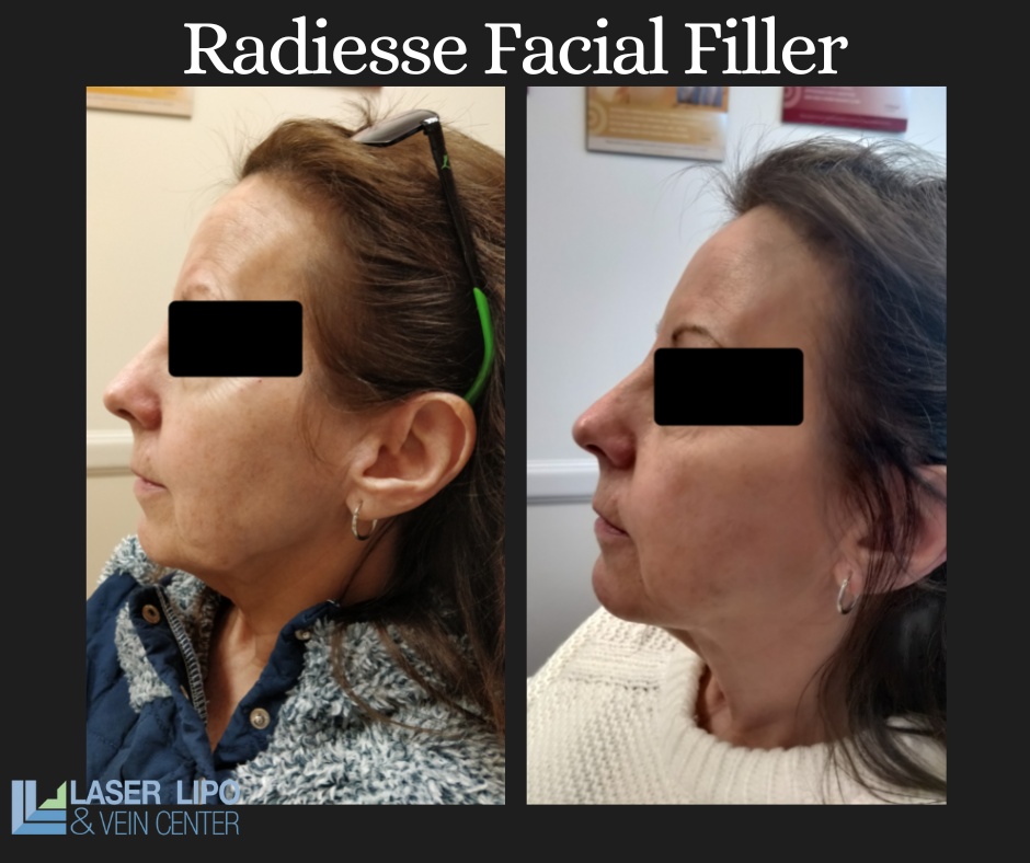 Radiesse Dermal Fillers and Injections in St. Louis | St. Louis Laser ...