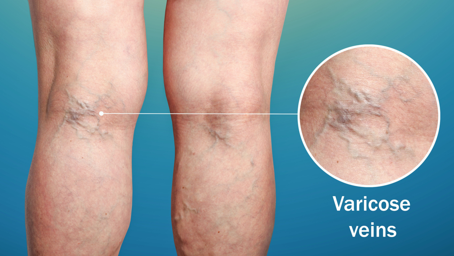 A Comprehensive Guide to Sclerotherapy - Is it Right for You? - St ...