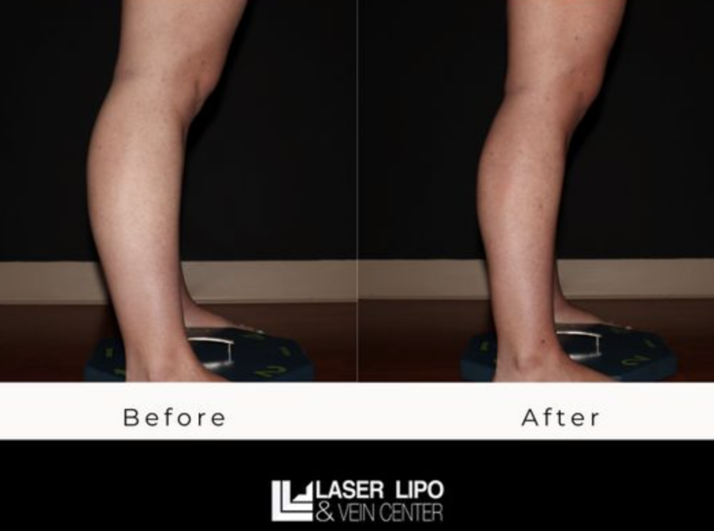 Get Ready For Summer Shorts & Skirts With Ankle or Calf Liposuction ...