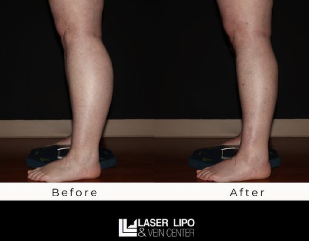 Get Ready For Summer Shorts & Skirts With Ankle or Calf Liposuction ...
