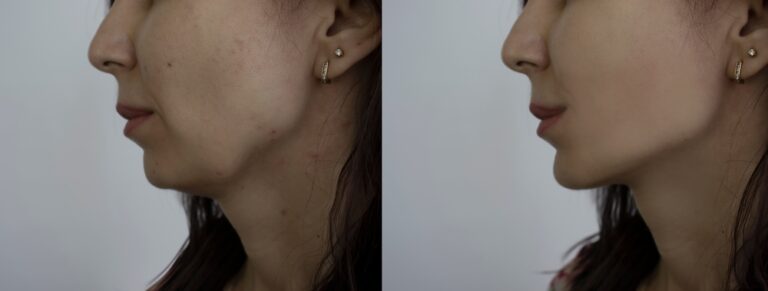 Contouring the Lower Face | St Louis Lipo