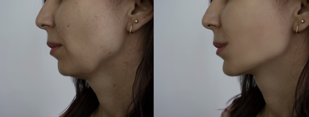 Contouring the Lower Face | St Louis Lipo