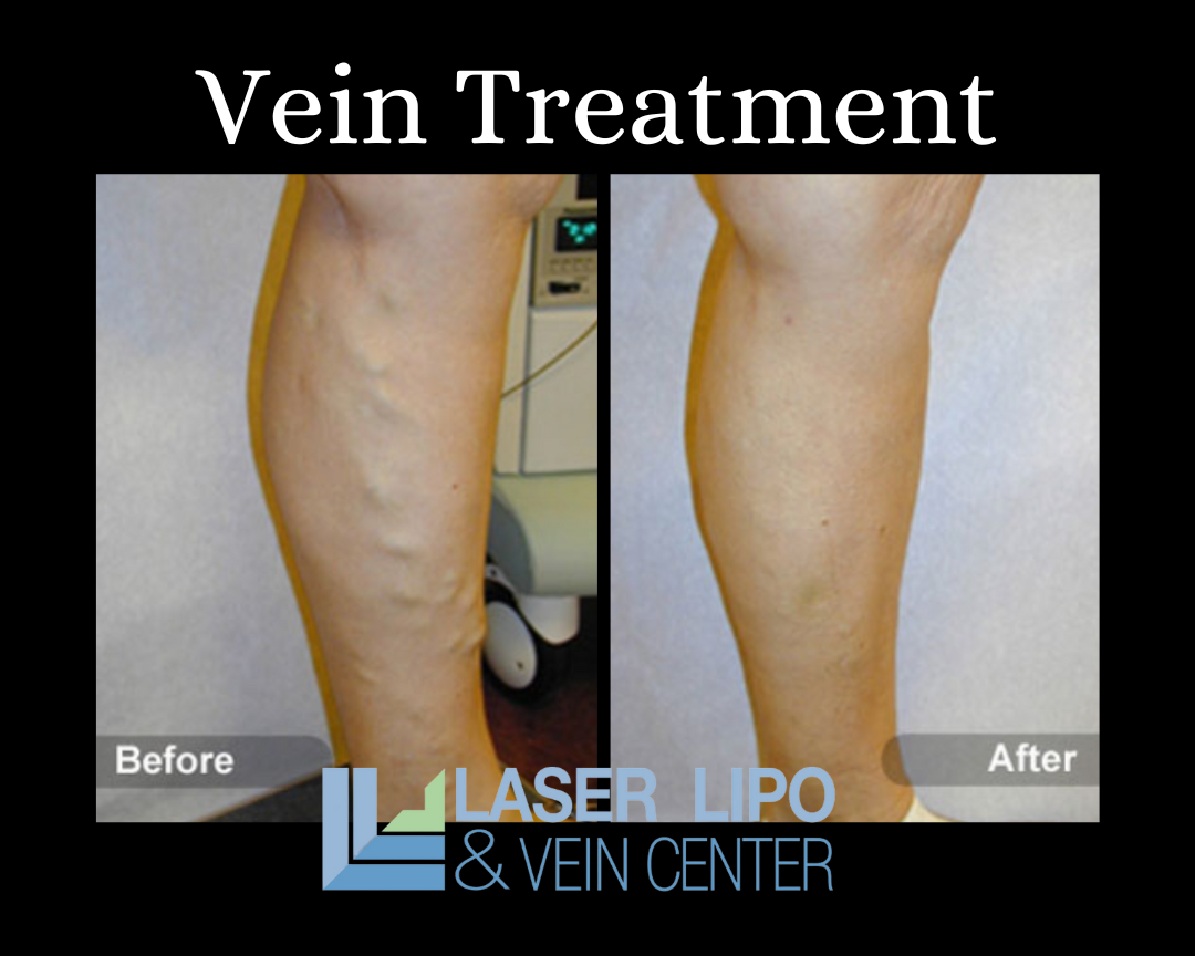 Say Goodbye to Varicose Veins: Exploring Modern Vein Treatment Options ...