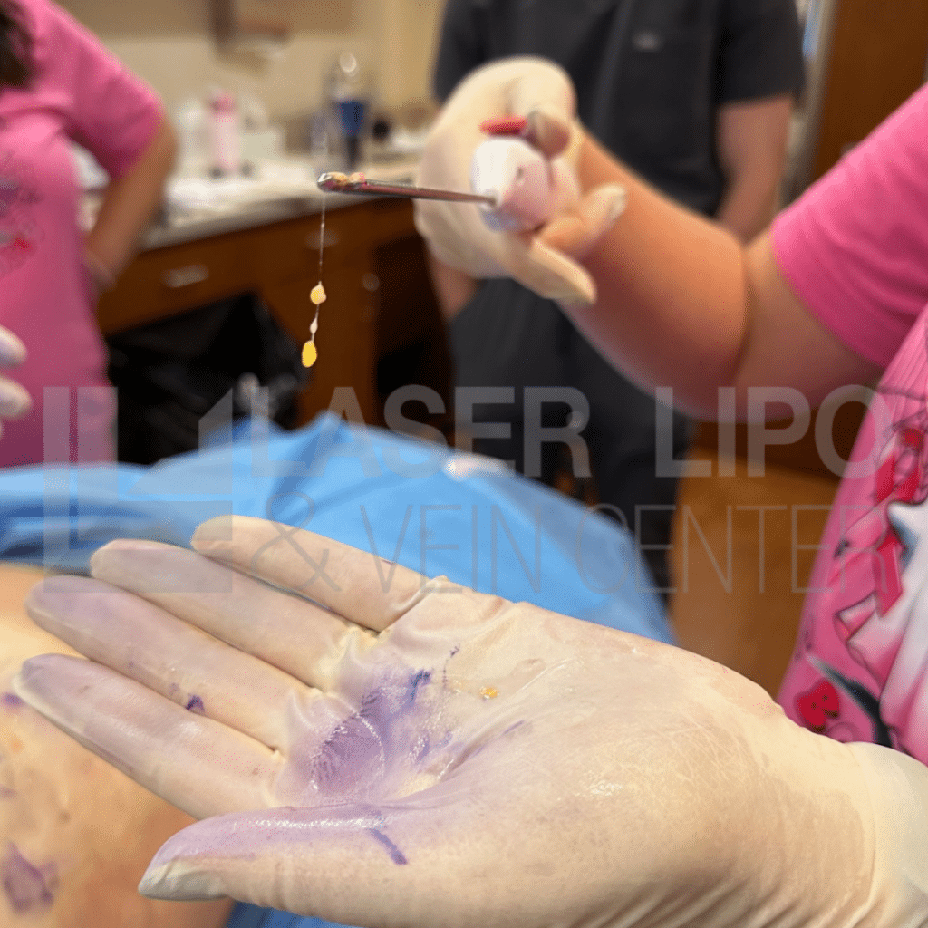 Is Aveli Right for You? A Guide to Understanding Cellulite Treatment ...